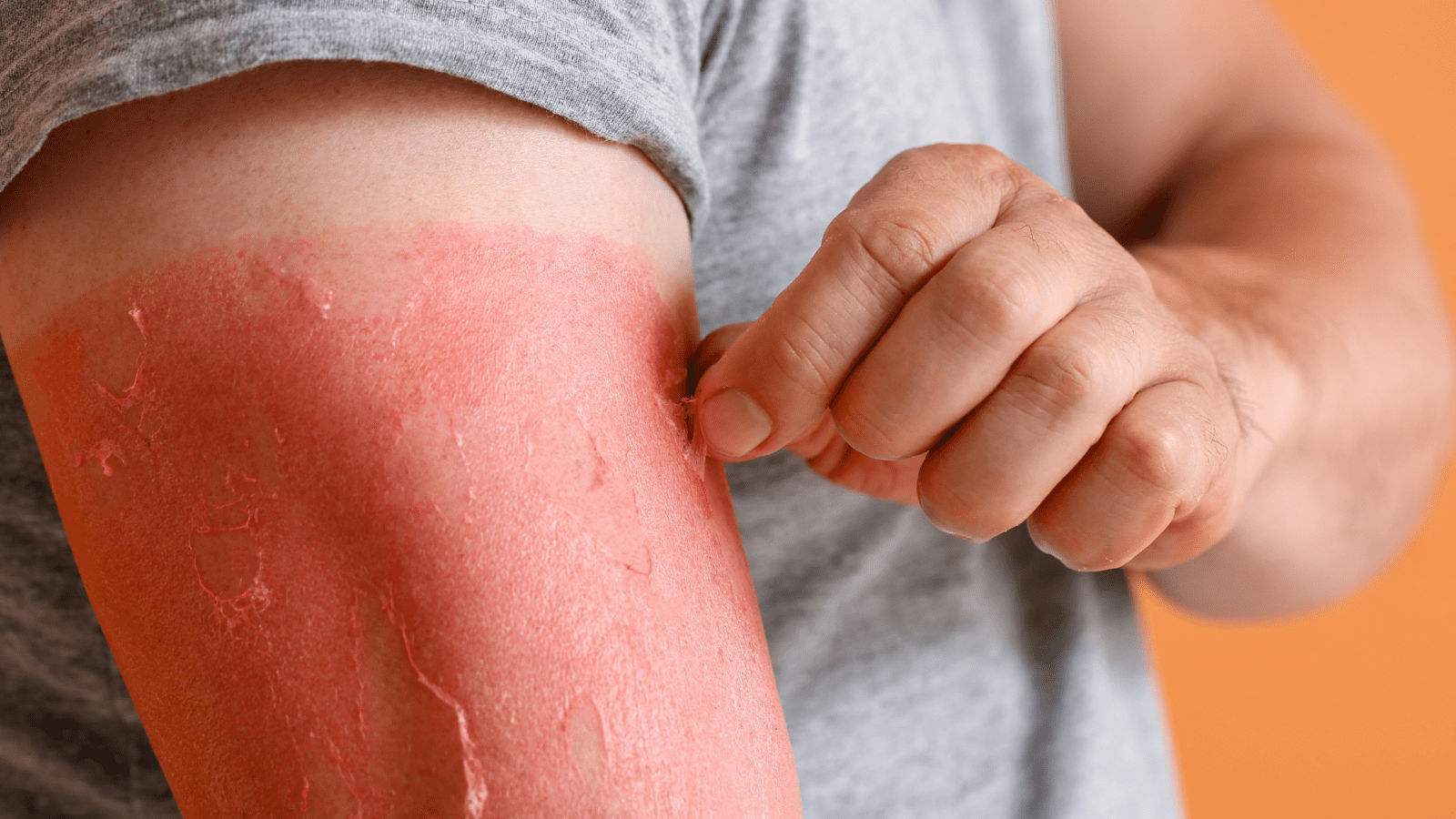 Vitamin D Synthesisi Sunlight Exposure